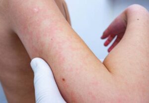 Gamot sa Bungang Araw ng bata - Sanhi, sintomas at Prevention - GamotPedia