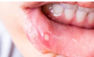 Sanhi ng singaw sa bibig ng bata : Paano makaiwas - GamotPedia